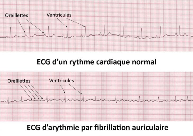 Prévention de l’AVC avec son smartphone ? – Club Cœur et Santé de Saint-Dié