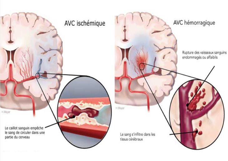 40 ans de progrès en cardiologie. Chapitre 7 : l’accident vasculaire ...